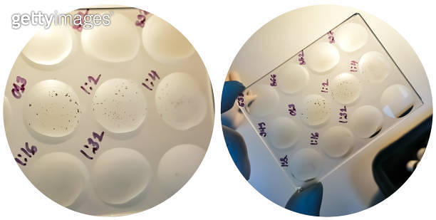 College Of Two Image Of Rpr Vdrl Syphilis Test Glass Slide Agglutination Method Showing