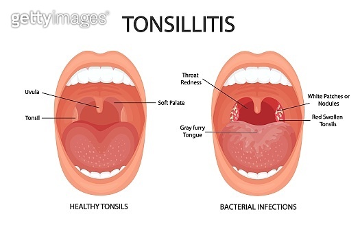 Angina, pharyngitis and tonsillitis. Tonsillitis is bacterial. Tonsil infection. Open mouth ...