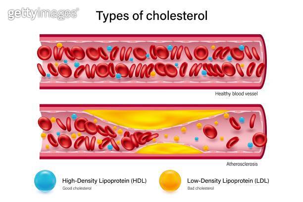 Types of cholesterol vector. Comparison of High-Density Lipoprotein ... Types of cholesterol vector. Comparison of High-Density Lipoprotein ...