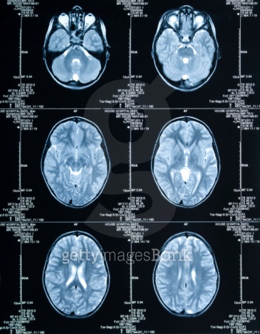 MRI Scan of Human Head and Brain (104104685) - 게티이미지뱅크
