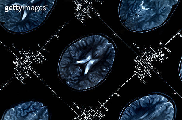 MRI Brain Scan showing multiple images of head and skull (104691188 ...