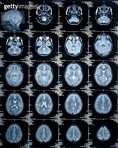 MRI Brain Scan showing multiple images of head and skull (104691203 ...