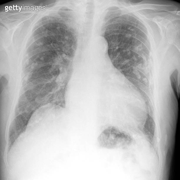 Digital chest x-ray showing multiple calcified pleural plaques from ...