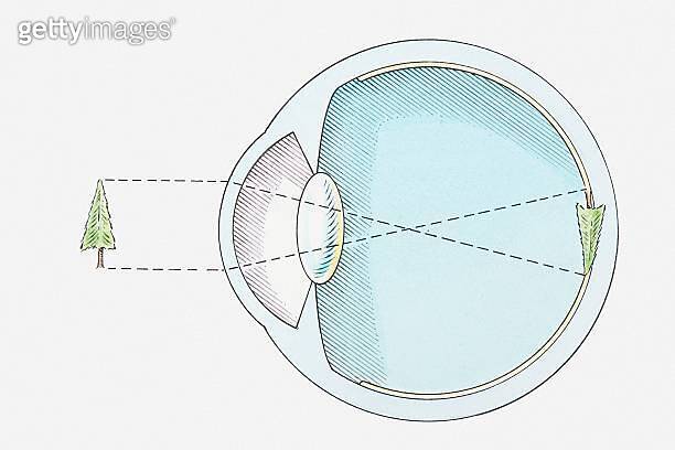 Illustration of cross-section through eye, illustrating normal vision ...