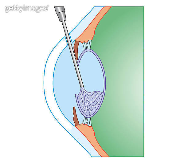 Cross section biomedical illustration of eye cataract surgery sucking ...