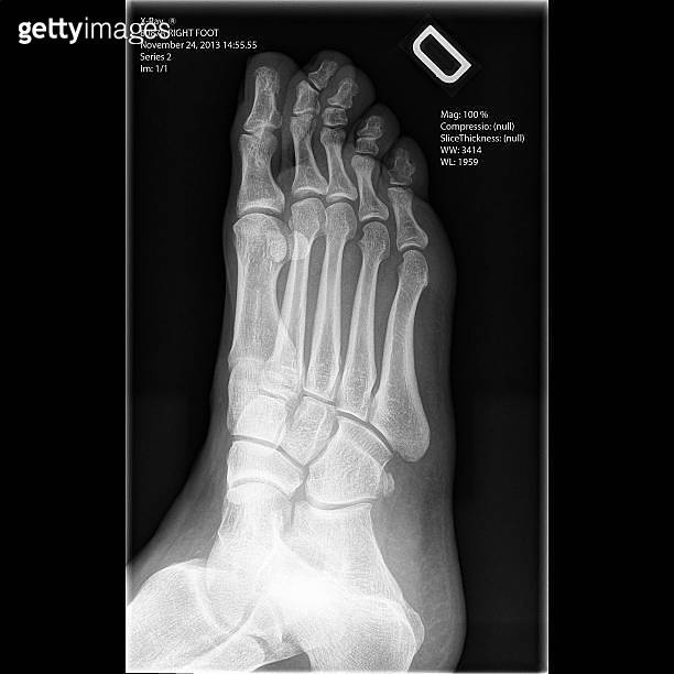 X-ray man's right foot - oblique view (187387065) - 게티이미지뱅크
