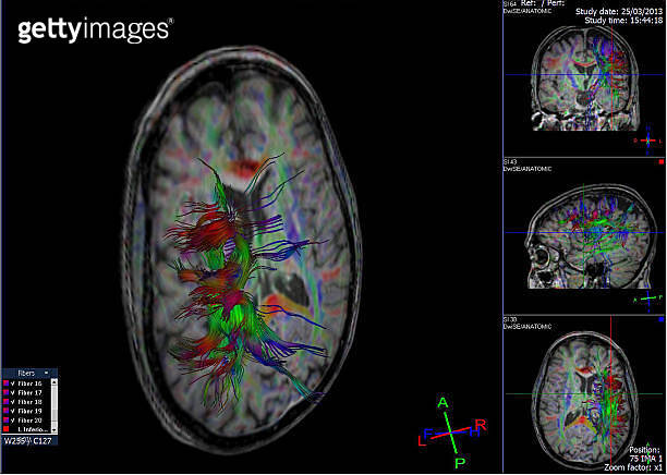 Tractography (DTI- diffusion tensor imaging MRI) of the brain ...