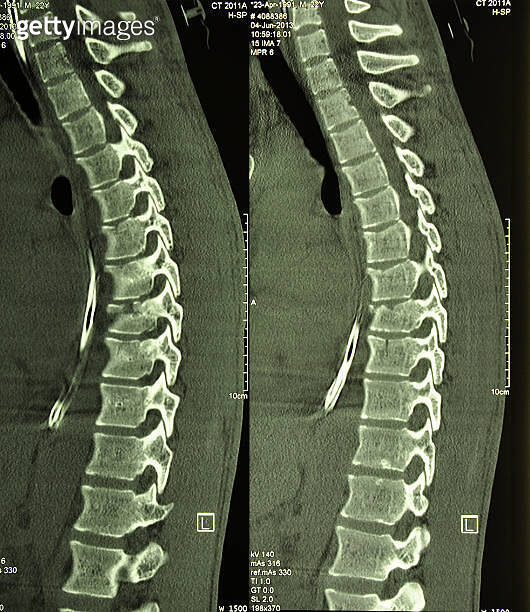 Spine CT (computed tomography) scan 이미지 (175720324) - 게티이미지뱅크