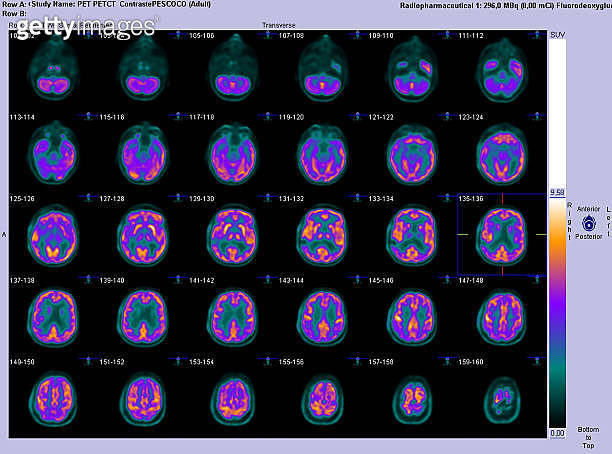 PET-CT axial scan of the brain 이미지 (453449409) - 게티이미지뱅크