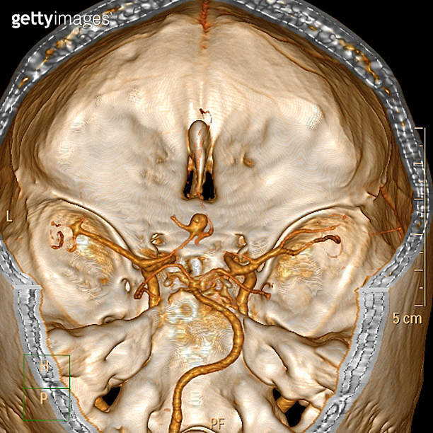 3D Computed tomography angiography (CTA) reconstruction of a bra ...