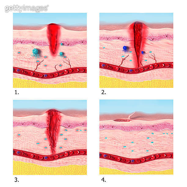 tissue repair of human skin 이미지 (461806767) - 게티이미지뱅크