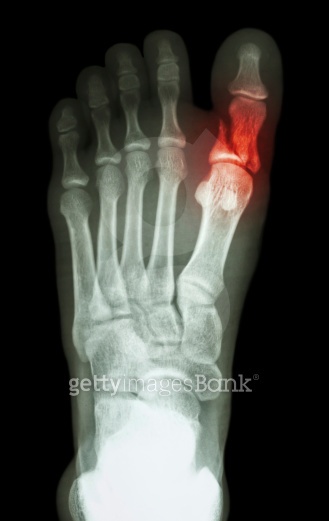 fracture proximal phalange at first toe 이미지 (490823633) - 게티이미지뱅크
