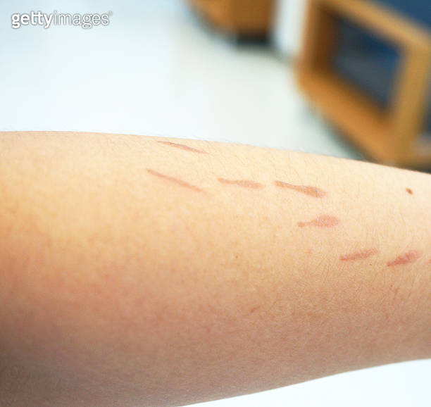Second degree scald burn blister on forearm 이미지 (482308109) - 게티이미지뱅크