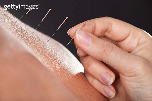 Man Getting Acupuncture Treatment 이미지 (495716509) - 게티이미지뱅크