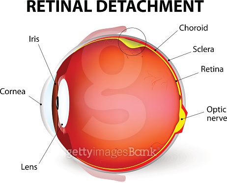 Retinal detachment. Vector diagram 이미지 (499230463) - 게티이미지뱅크