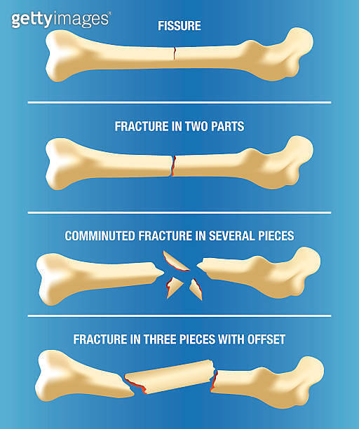 Anatomy multiple bone fractures of the skeleton (522782903) 일러스트, 무료 ...