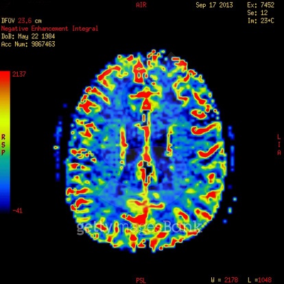 Perfusion MR imaging of a normal brain (464153343) - 게티이미지뱅크