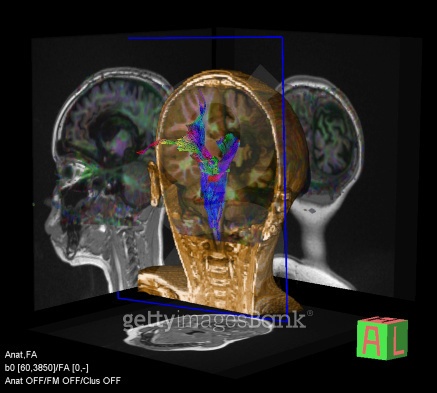 Tractography (DTI- diffusion tensor imaging MRI) of the brain ...