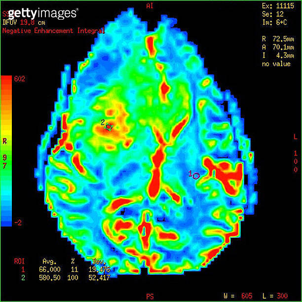 Perfusion MRI imaging of a malignant brain tumor 이미지 (481267469) - 게티이미지뱅크