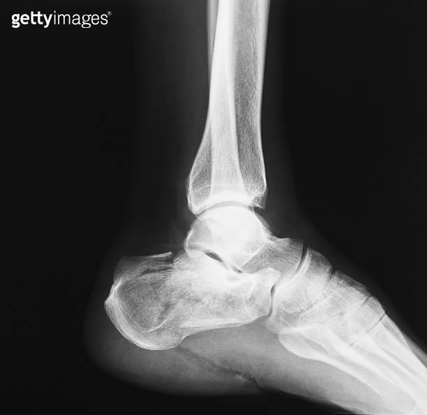 X-ray image of calcaneus fracture. Lateral view. (489345826) - 게티이미지뱅크