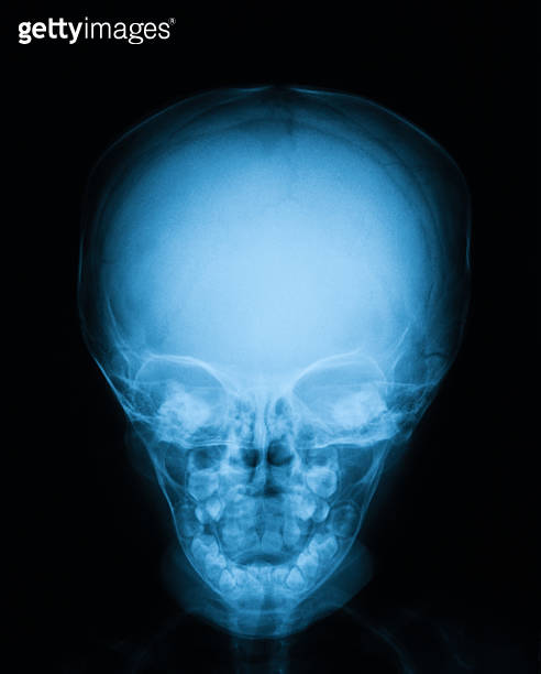 X-ray image of baby skull, front view. (486529776) - 게티이미지뱅크