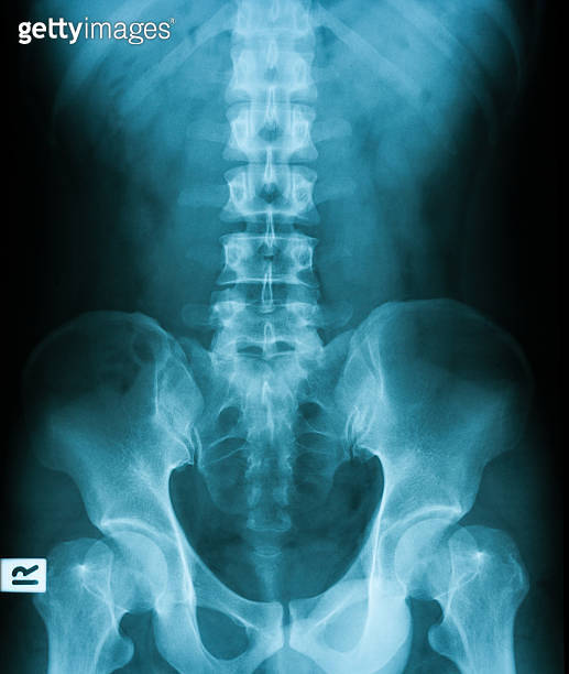 X-ray image of plain KUB (kidney, ureter and bladder). (472215864) - 게티 ...