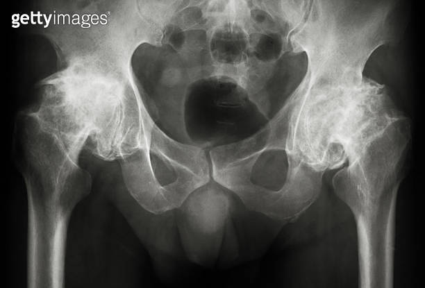X-ray image of both hip, AP view, (477511574) - 게티이미지뱅크