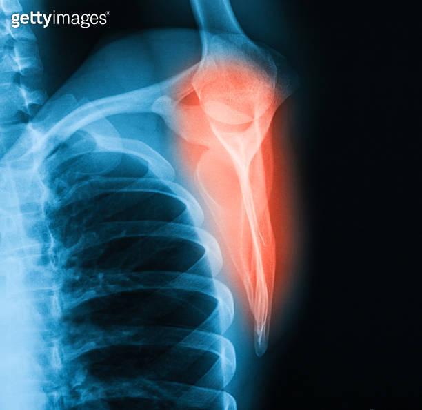 X-ray image of Shoulder, transcapular y view. (489434934) - 게티이미지뱅크