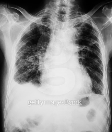 Chest x-ray image, AP upright view. Showing lungs infection. (489348502 ...