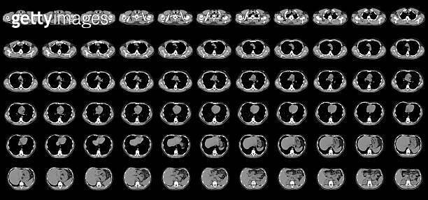 Normal chest on CT 이미지 (484327272) - 게티이미지뱅크