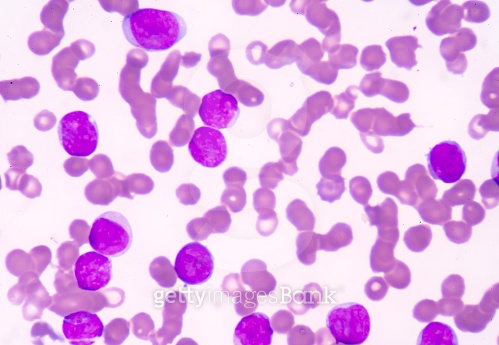 Medical science background showing blast cells(AML) 이미지 (501518020 ...