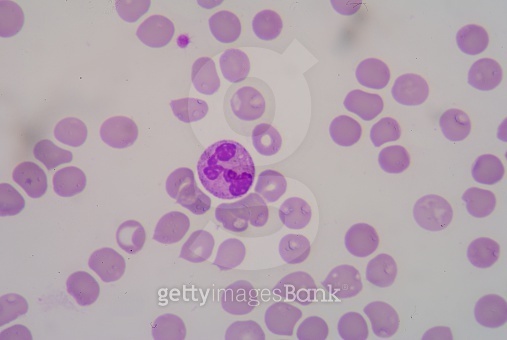 Red blood cells form microcytosis. 이미지 (464853140) - 게티이미지뱅크