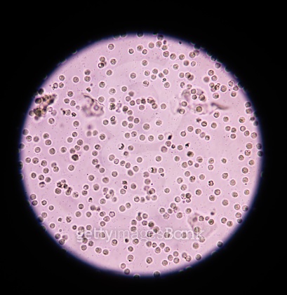 white blood cells in urine specimen under microscope 400x. (484441348 ...