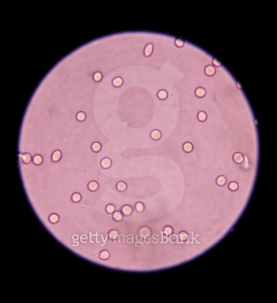 fresh red blood cells in urine specimen under microscope 400x. 이미지 ...