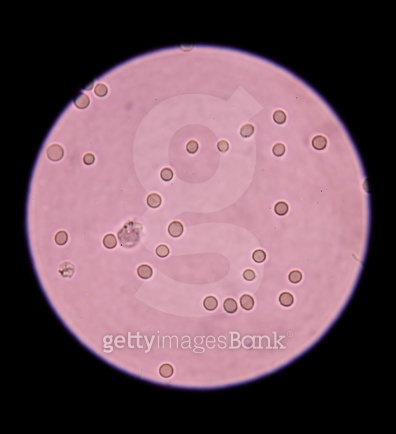 fresh red blood cells in urine specimen under microscope 400x. 이미지 ...