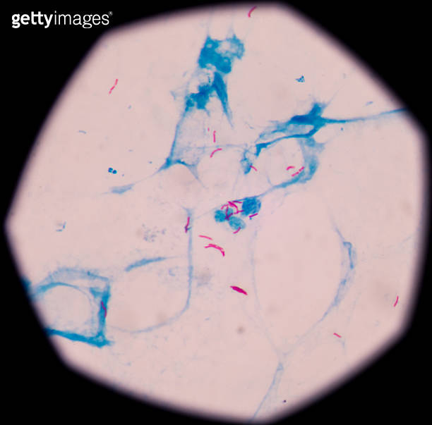 Bacterial infection tuberculosis.red cells in blue background.AF ...