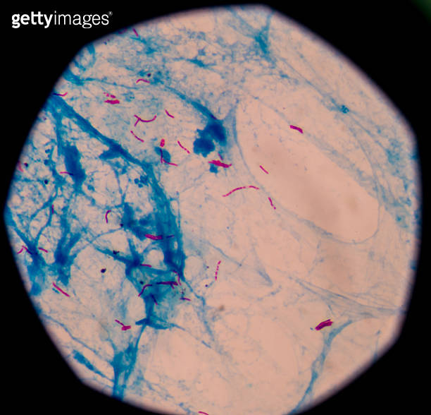 Bacterial infection tuberculosis.red cells in blue background.AF ...