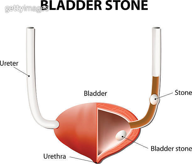 Stones in the urinary bladder and ureter 이미지 (531888225) - 게티이미지뱅크