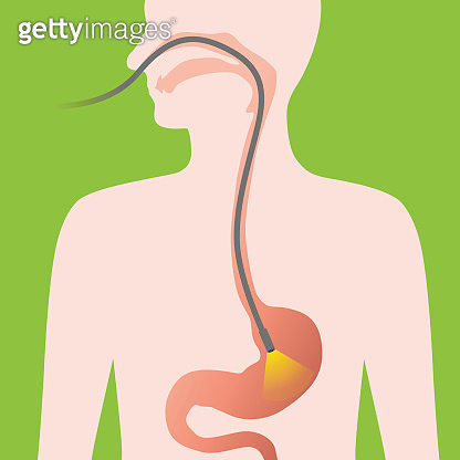 nasal endoscope, gastroscopy, vector illustration 이미지 (610586292) - 게티이미지뱅크