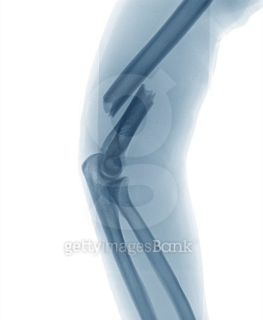 Humerus fracture with plaster cast x-ray image 이미지 (593340424) - 게티이미지뱅크