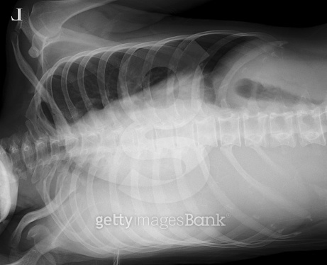 Right lateral decubitus chest x-ray (607650634) - 게티이미지뱅크