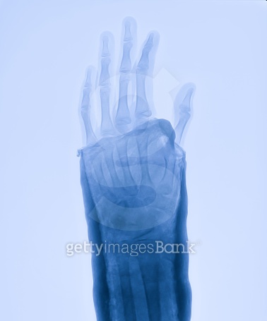 X-ray image of wrist joint with plaster cast (585184256) - 게티이미지뱅크