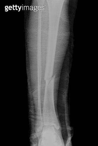 Broken leg with plaster cast x-ray image, (593337204) - 게티이미지뱅크