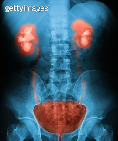 X-ray image of kidney, ureter and bladde (KUB) (613773318) - 게티이미지뱅크