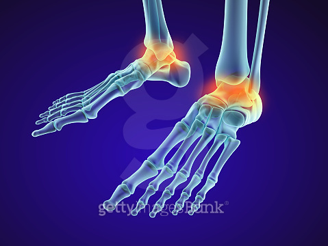 Skeletal foot - injuryd talus bone. Xray view. 이미지 (594059886) - 게티이미지뱅크