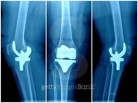 Artificial knee joint 이미지 (584593496) - 게티이미지뱅크