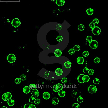 Leukemic cells labeled with fluorescent molecules 이미지 (512754348) - 게티이미지뱅크