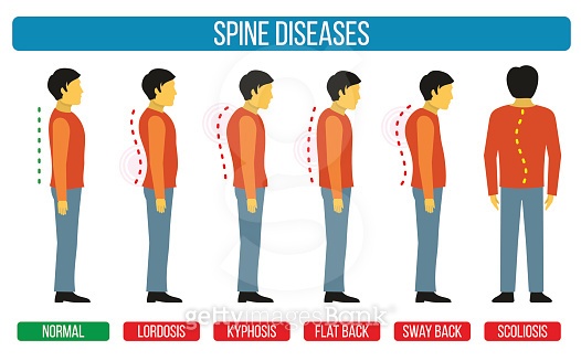 Body posture defect. Vector infographics of spine diseases (532399922 ...