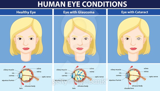 Diagram showing human eye conditions (583827338) 일러스트, 무료 일러스트 - 게티이미지뱅크