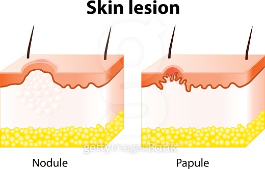 Skin lesion 이미지 (504876938) - 게티이미지뱅크